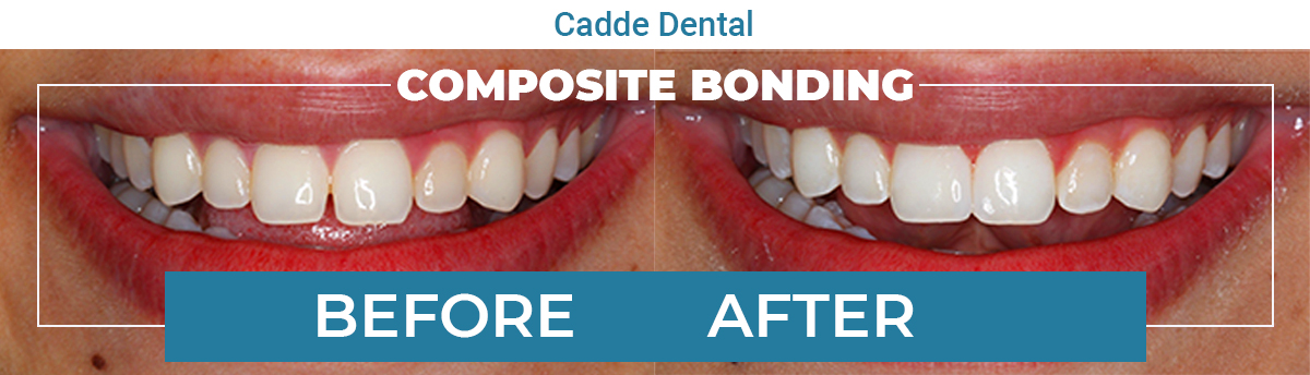 Study on Dental Bonding Treatment - Cadde Dental Clinic